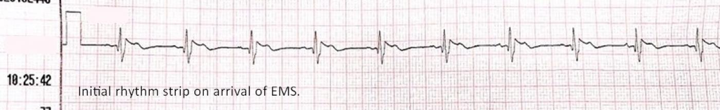 Shark Fin Pattern | ECG Guru - Instructor Resources